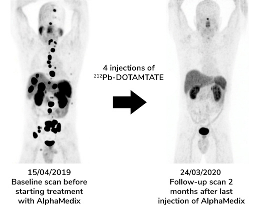 Targeted Alpha Therapy | Orano Med